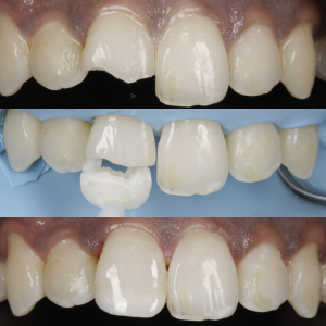 Emergency Dental Repair London | Smile Makeovers London
